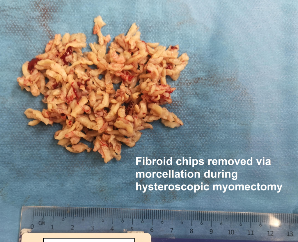Fibroids removal (Myomectomy) – Women's Health by Dr Lee Say Fatt