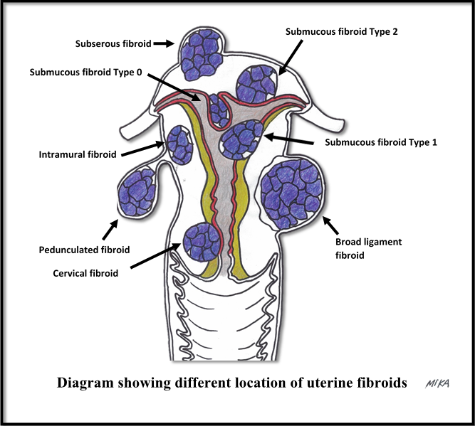 Uterine Fibroids Women s Health By Dr Lee Say Fatt Uterine Fibroids Women s Health By Dr Lee Say Fatt