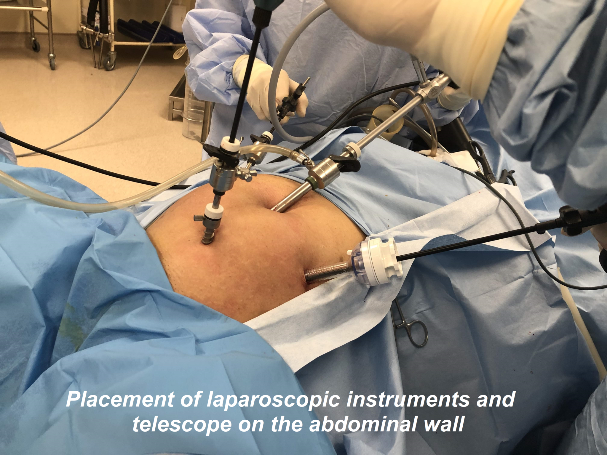 Laparoscopy in Gynaecology – Women's Health by Dr Lee Say Fatt