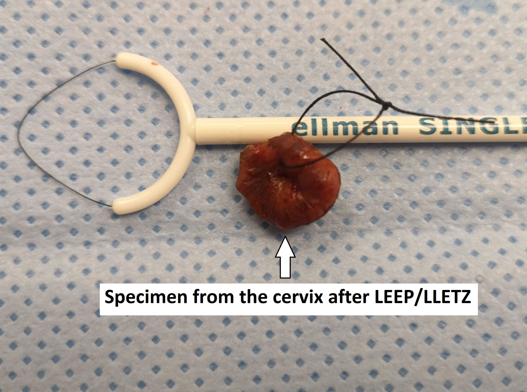 Loop Electrosurgical Excision Procedure (LEEP/LLETZ) for CIN – Women's ...