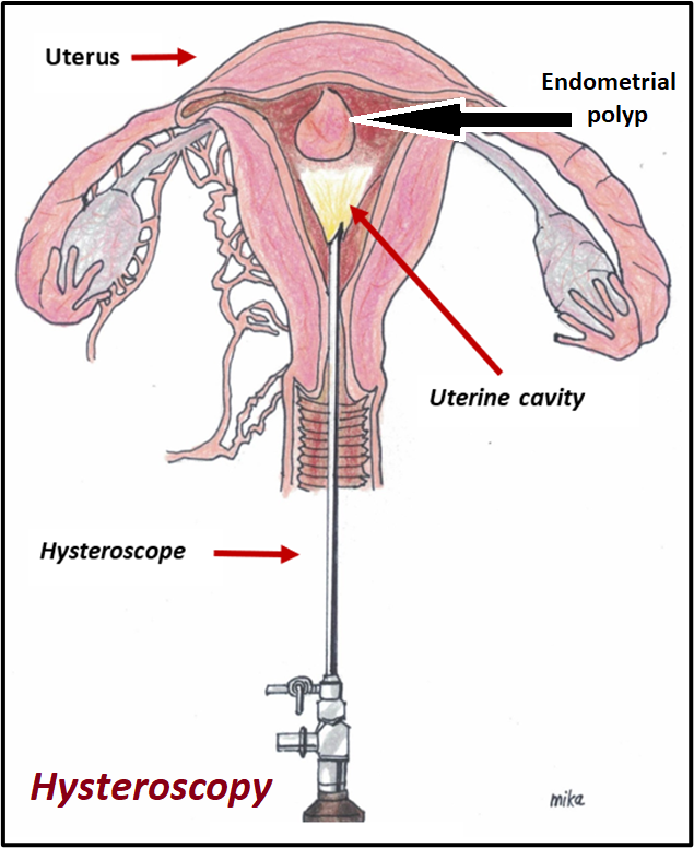 What Do Polyps In The Uterus Mean Infoupdate What Do Polyps In The Uterus Mean Infoupdate